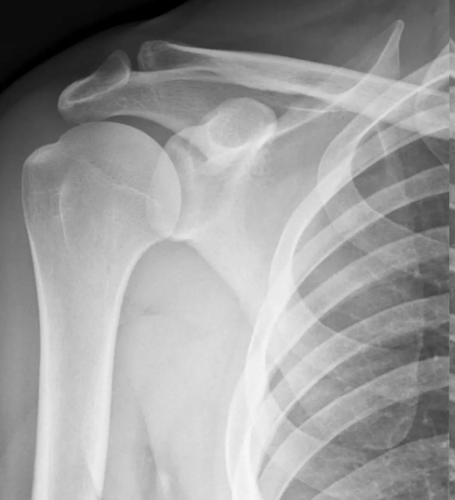Advanced Shoulder Surgery Solutions - Knee Clinic Lincoln